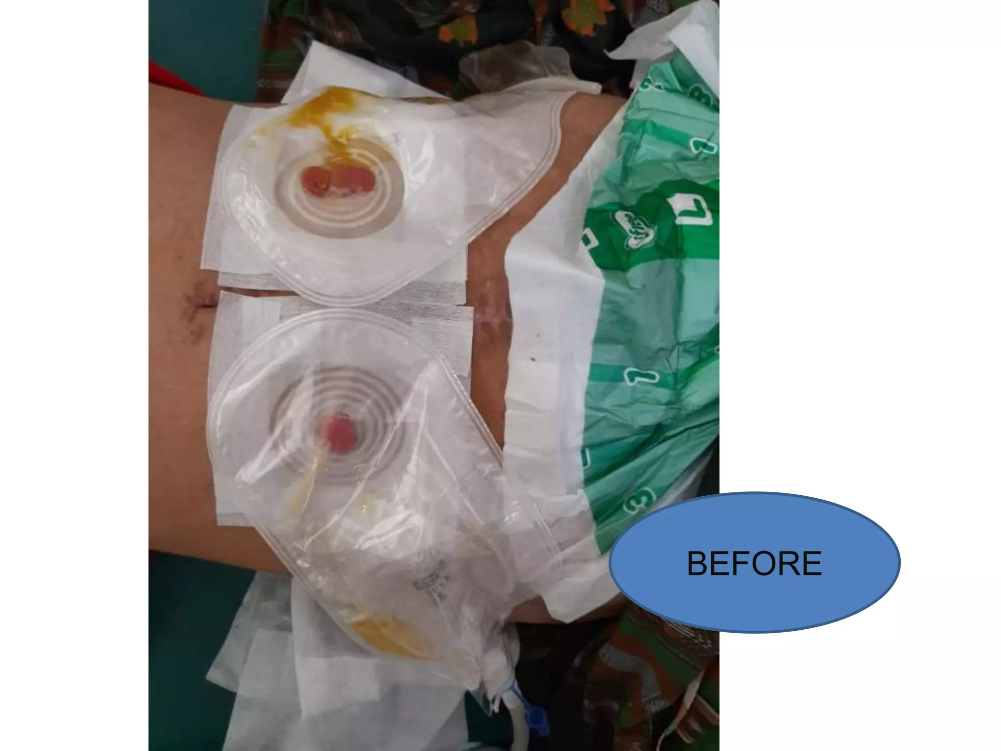 Perawatan Stoma Pasien Post Operasi | PPTX