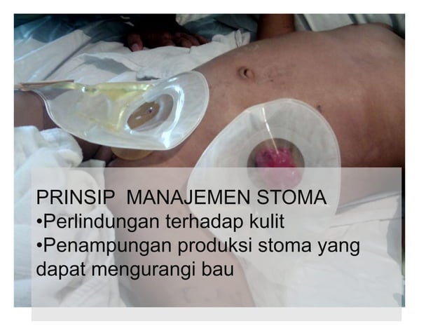 Perawatan Stoma Pasien Post Operasi | PPTX