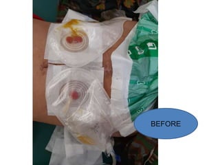 Perawatan Stoma Pasien Post Operasi | PPTX