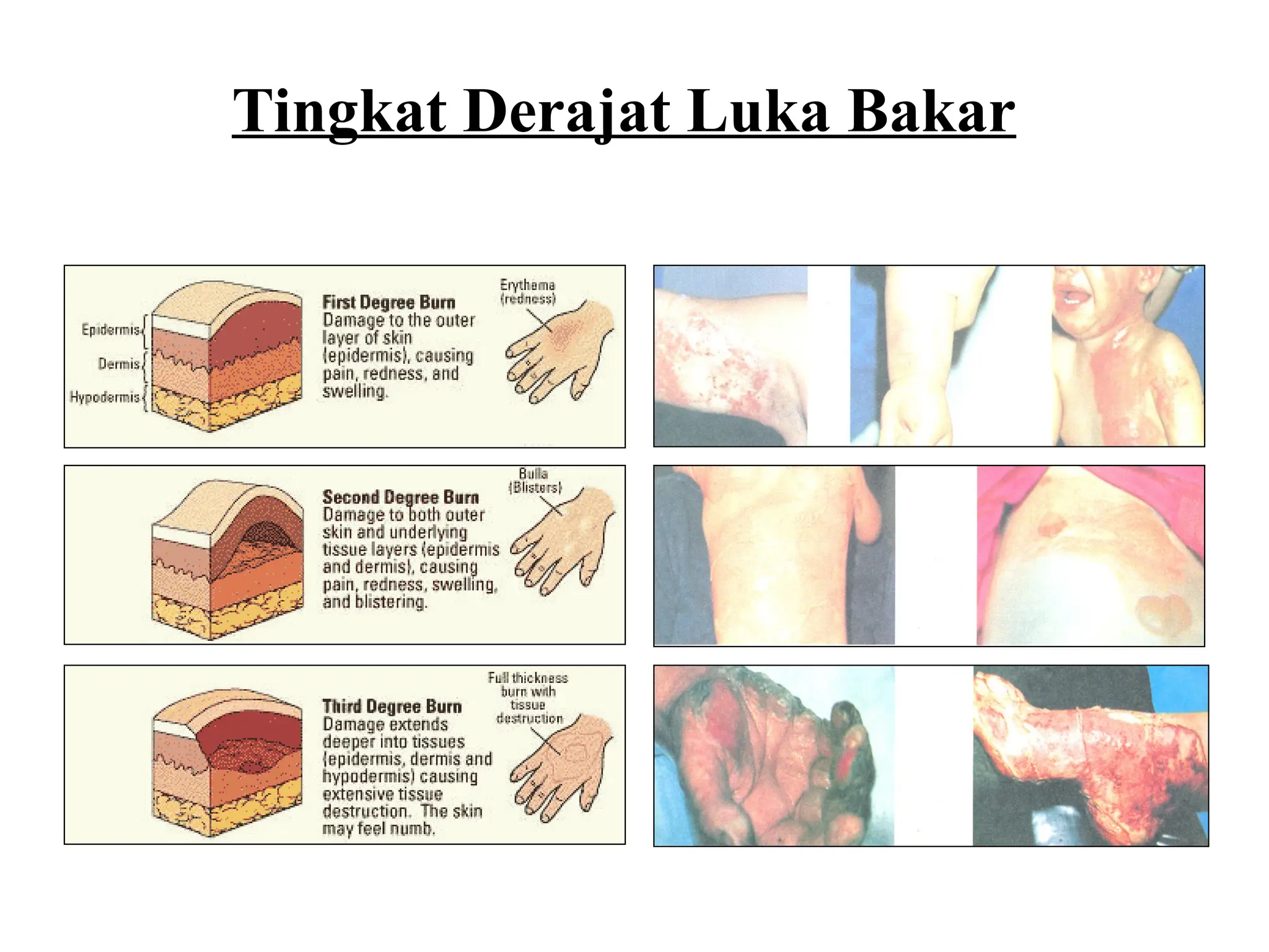 lukabakar- cara pertolongan pertama luka bakar | PPT