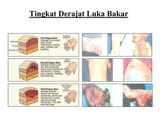 Luka bakar | PPT