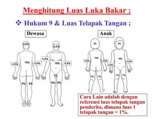 Luka bakar | PPT