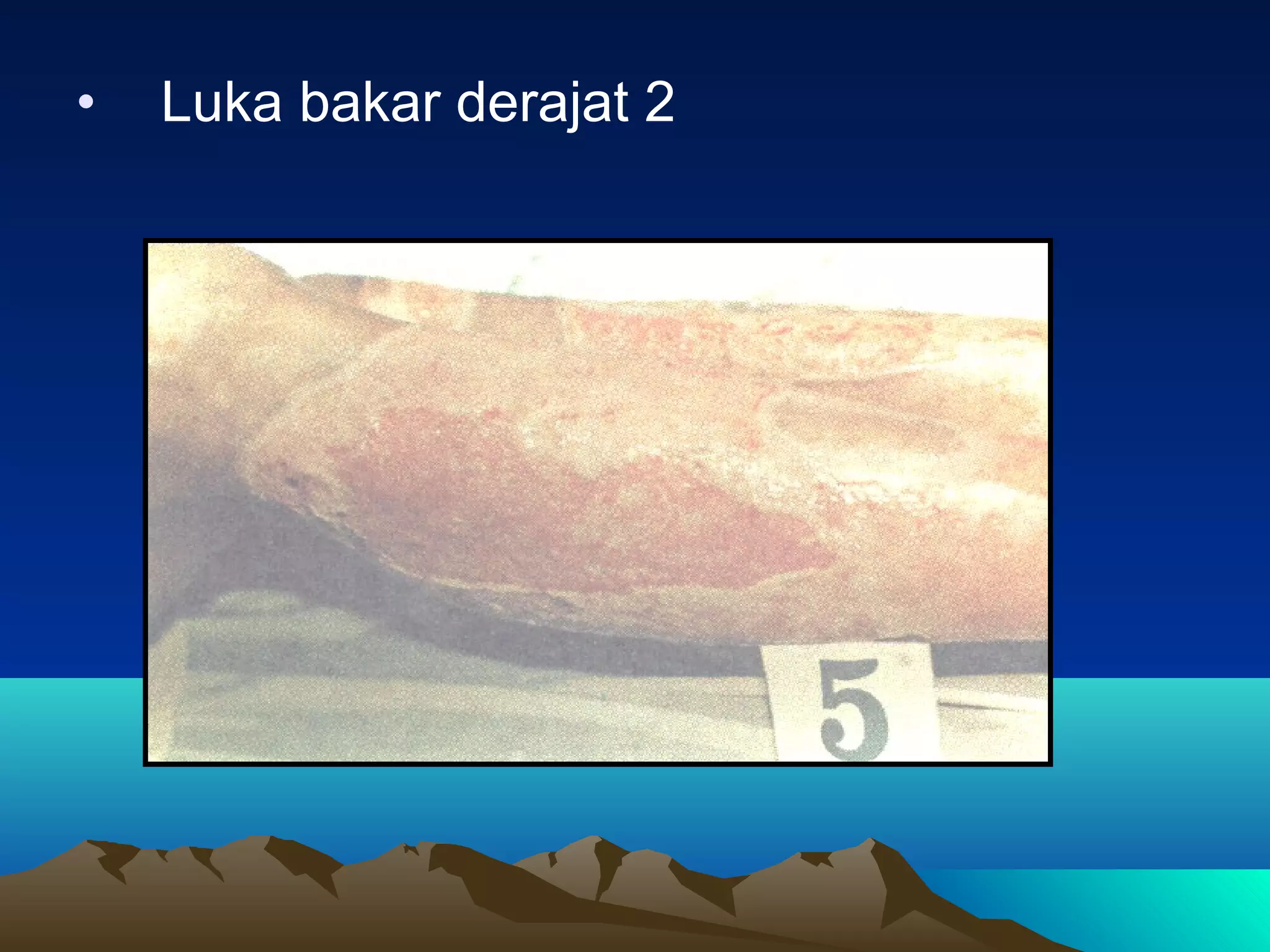 Luka bakar | PPT