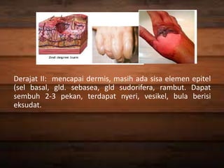 Luka Bakar (Combustio) dan Penanganan Pertama .pptx