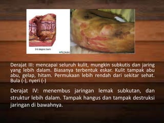 Luka Bakar (Combustio) dan Penanganan Pertama .pptx