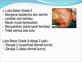PENTALAKSANAAN DIET TENTANG LUKA BAKAR.ppt