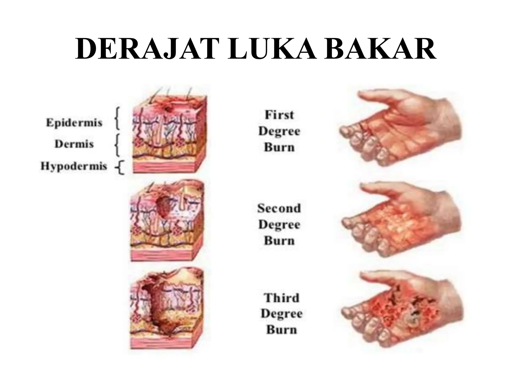 TATA LAKSANA LUKA BAKAR LUKA BAKAR (COMBUSTIO).pptx
