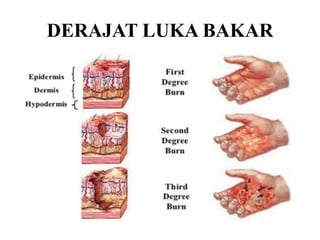 TATA LAKSANA LUKA BAKAR LUKA BAKAR (COMBUSTIO).pptx