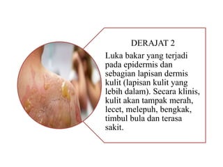 TATA LAKSANA LUKA BAKAR LUKA BAKAR (COMBUSTIO).pptx