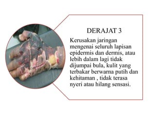 TATA LAKSANA LUKA BAKAR LUKA BAKAR (COMBUSTIO).pptx