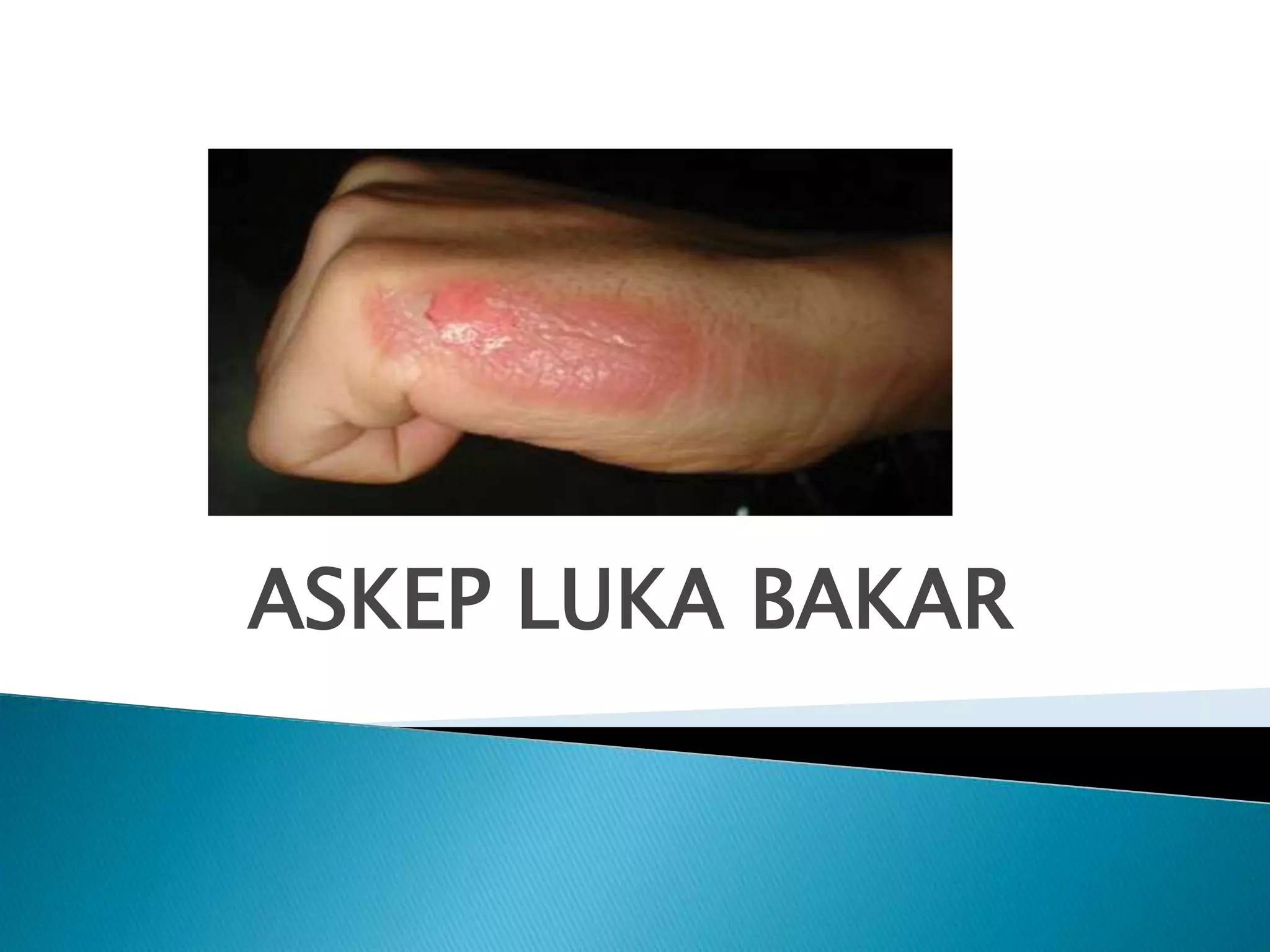 Luka bakar present 2011 | PPT