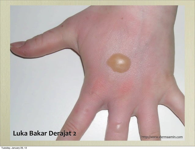 Penanganan Luka Bakar untuk Umum | PDF