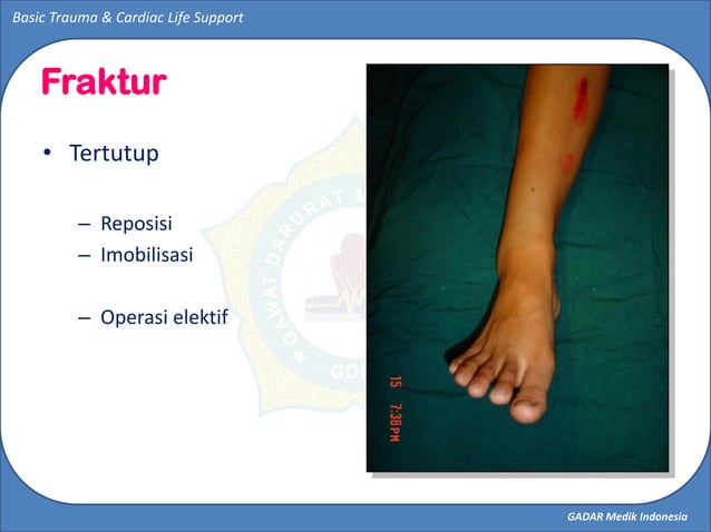 Trauma Luka Dan Fraktur | PDF