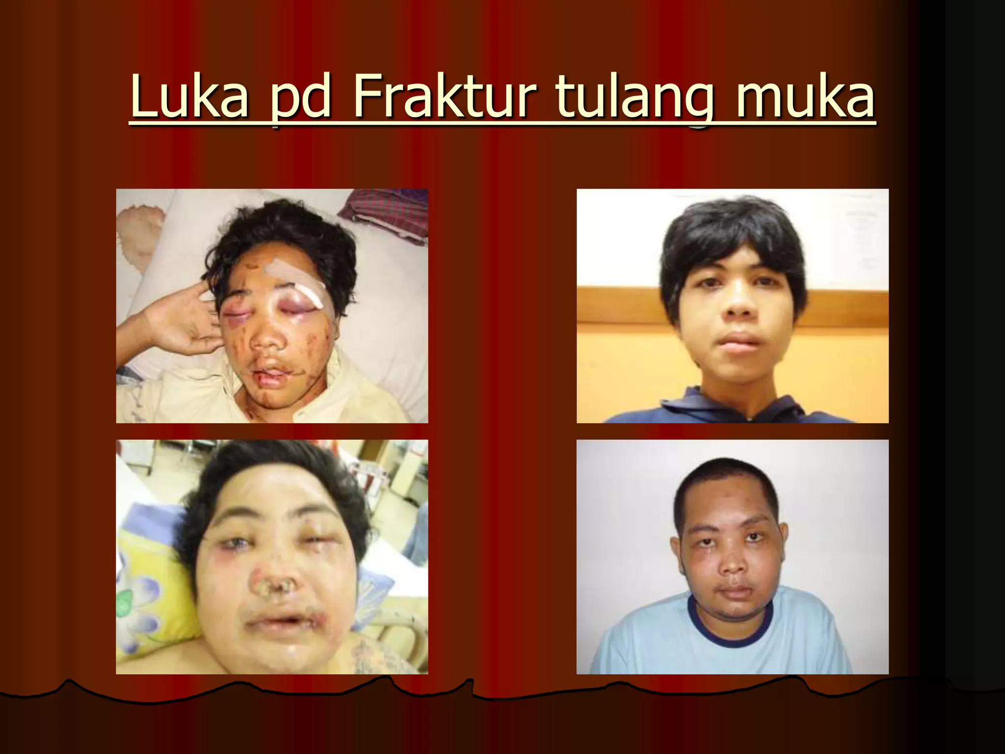Luka & debridement trauma plus | PPTX