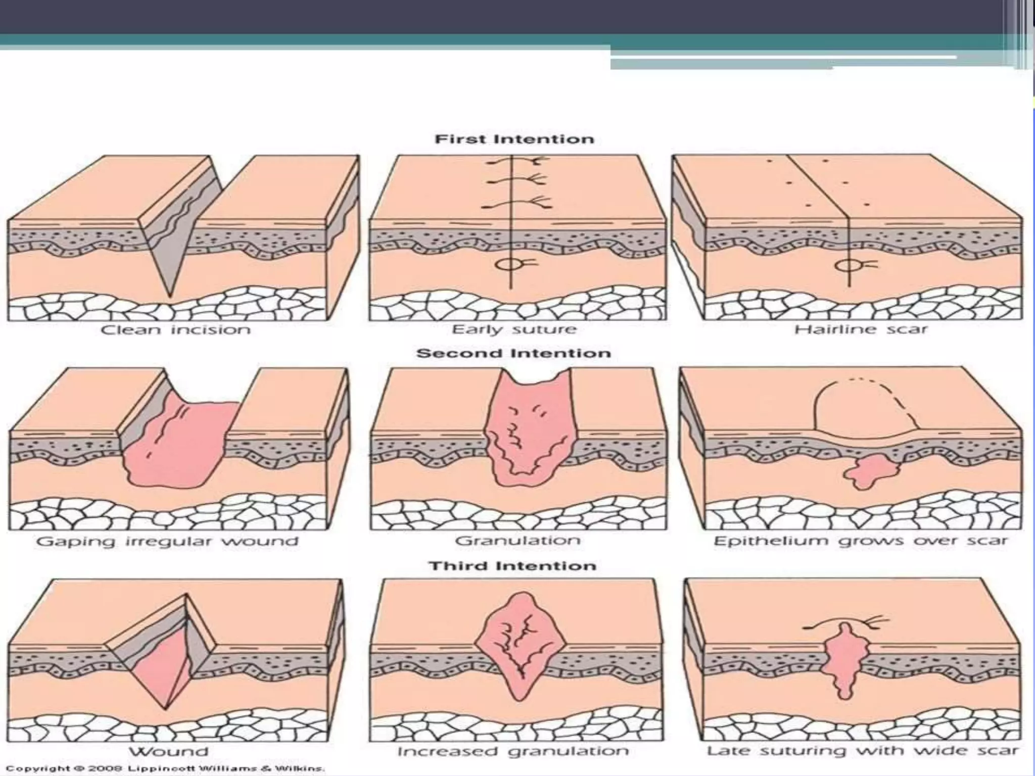 Luka pembedahan | PPT