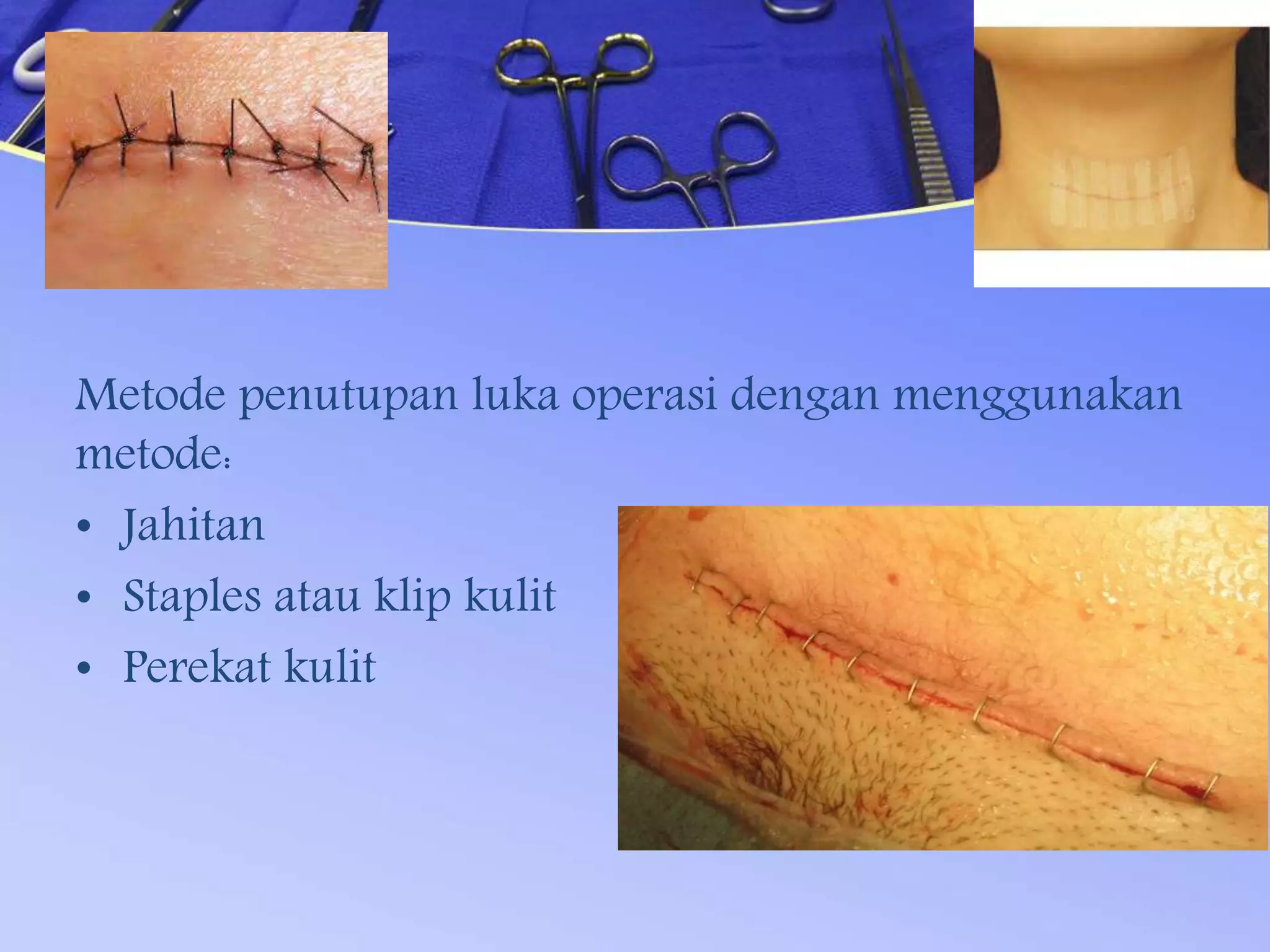 Luka pembedahan | PPT
