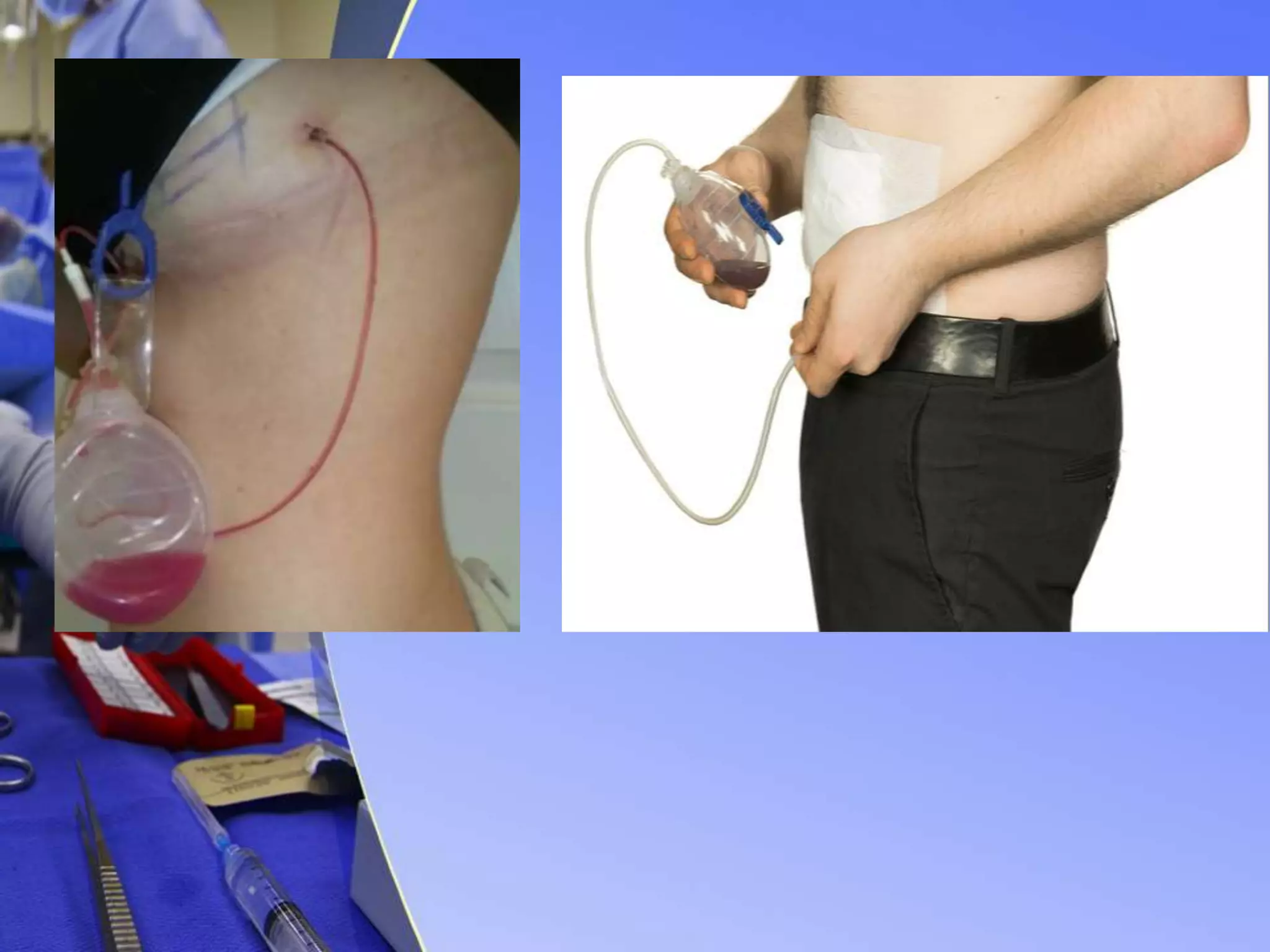 Luka pembedahan | PPT