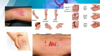 Luka traumatik | PPTX