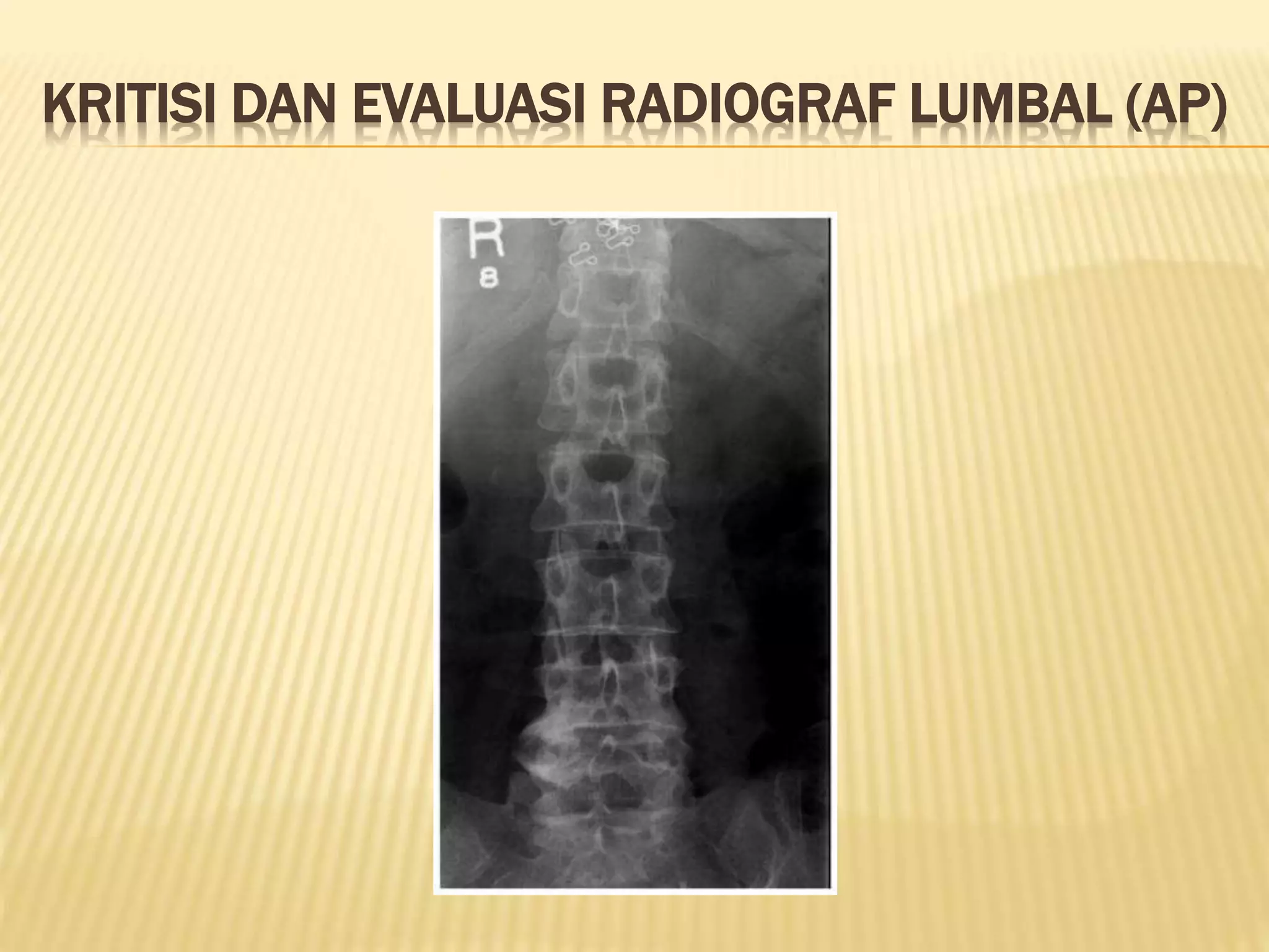 ppt kritisi dan evaluasi radiograf Lumbal dan Lumbosacral | PPTX