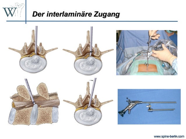 Endoskopische lumbale Bandscheibenoperation