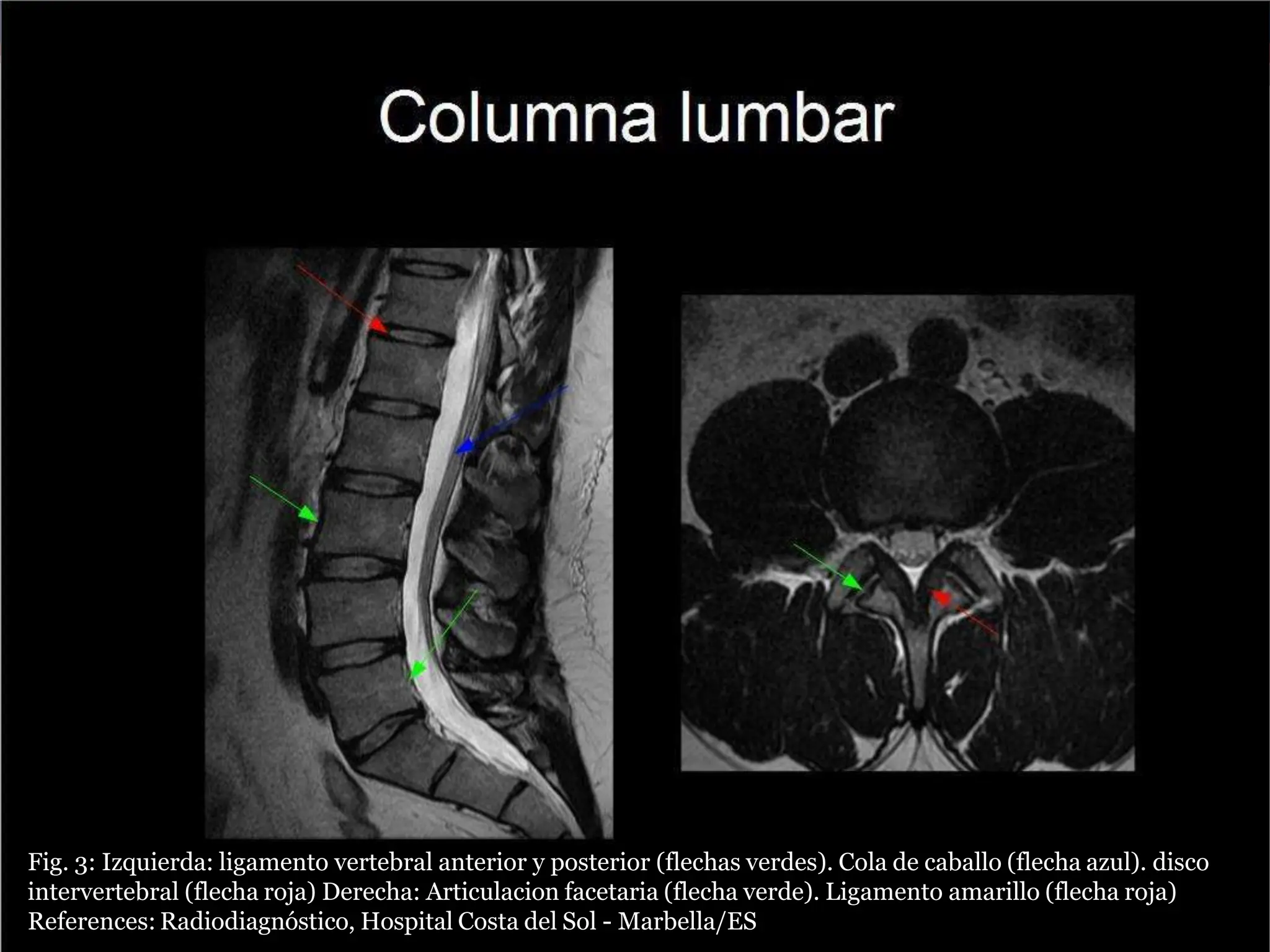 lumbalgia y su relación traumatología y ortopedia | PPTX