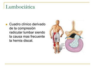 Lumbalgia aguda y lumbociatica | PPT