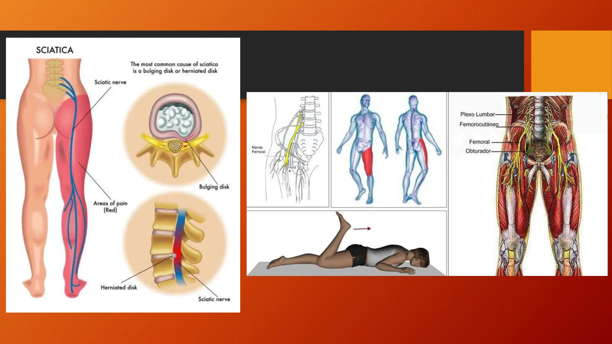 Lumbalgia, Lumbociatalgia y Cruralgia.pptx