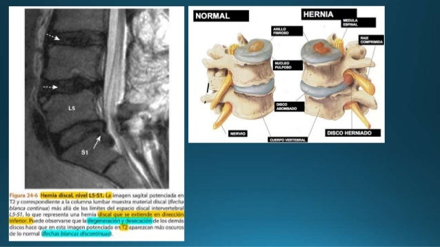 Lumbalgia y lumbociatica