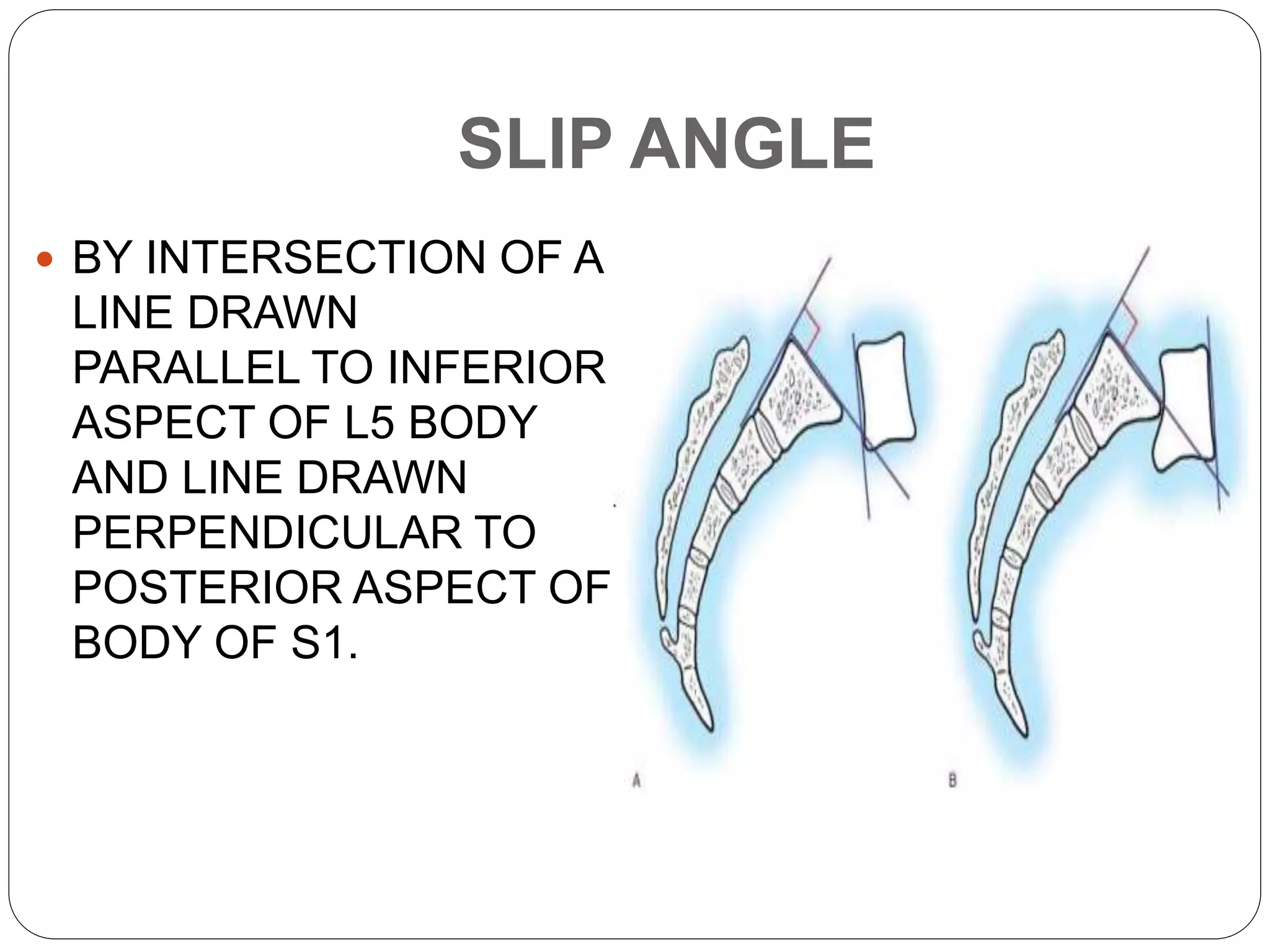 Lumbar Spondylosis, Spondylolisthesis and Radiculopathy | PPTX