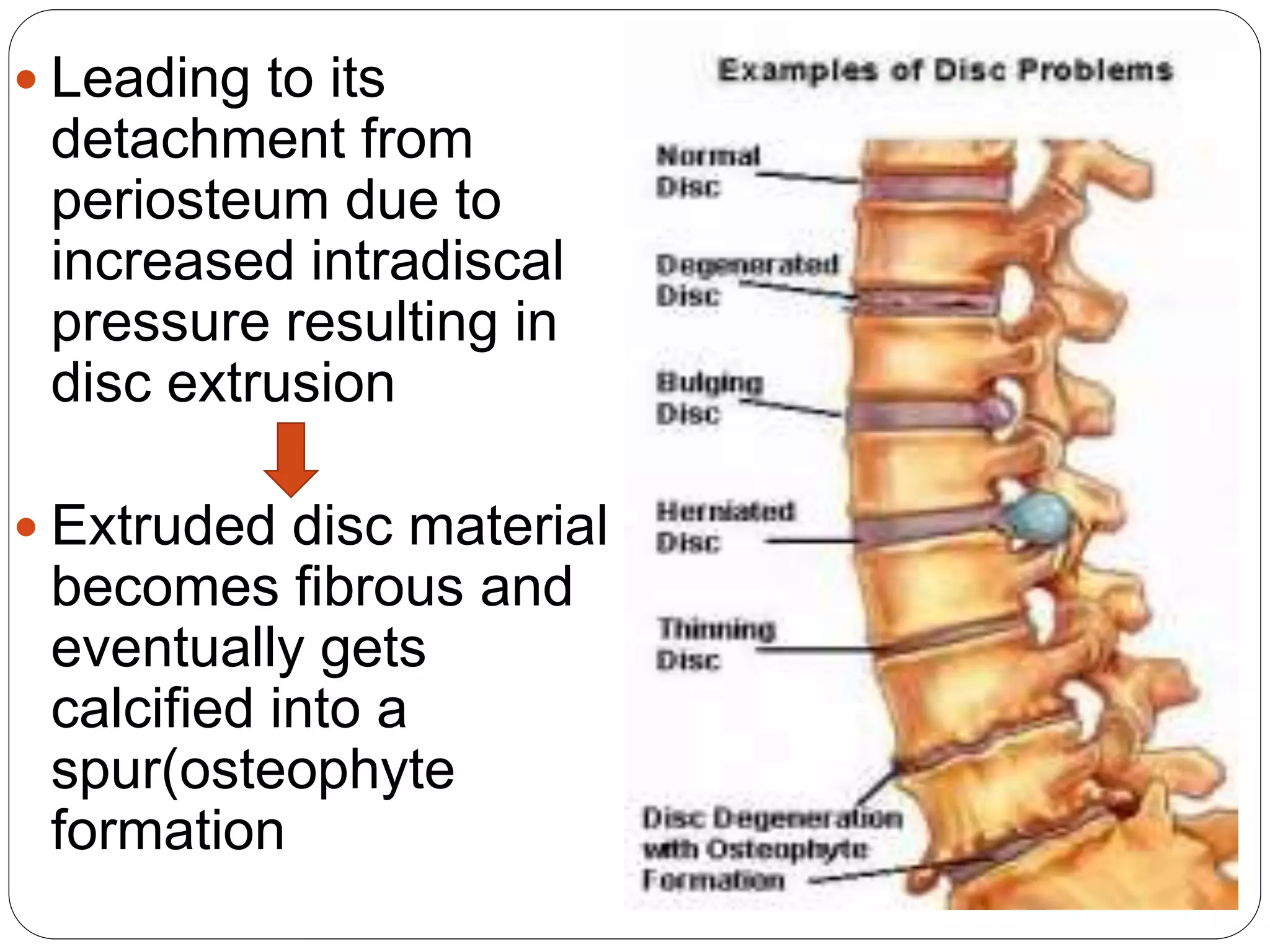 Lumbar Spondylosis, Spondylolisthesis and Radiculopathy | PPTX
