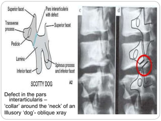 Spondylolisthesis X Ray Scotty Dog
