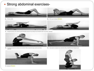 Spondylolisthesis Physical Therapy Exercises