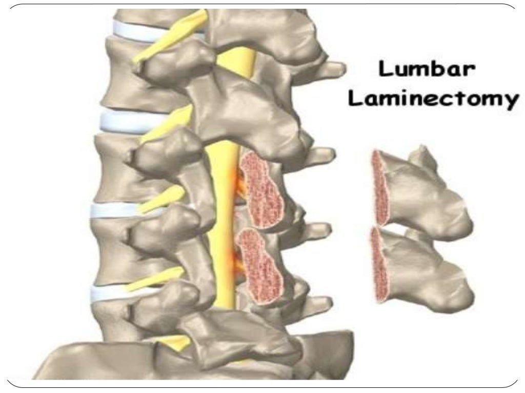 Lumbar Spondylosis, Spondylolisthesis and Radiculopathy