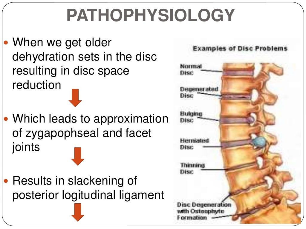 Lumbar Spondylosis, Spondylolisthesis and Radiculopathy