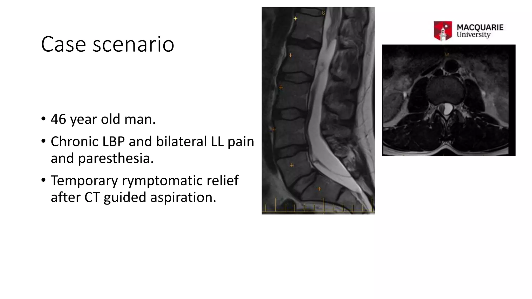 Lumbar ac ebs rev ms | PPTX