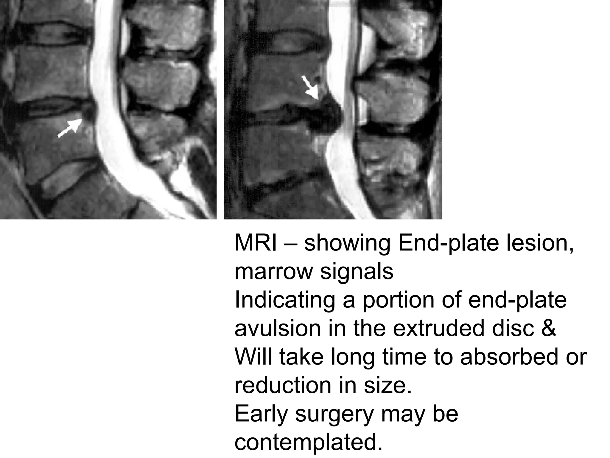 Lumbar Disc Herniation Naneria Part 1 | PPT