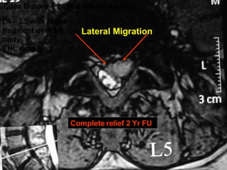 Lumbar Disc Herniation Naneria Part 1 | PPT