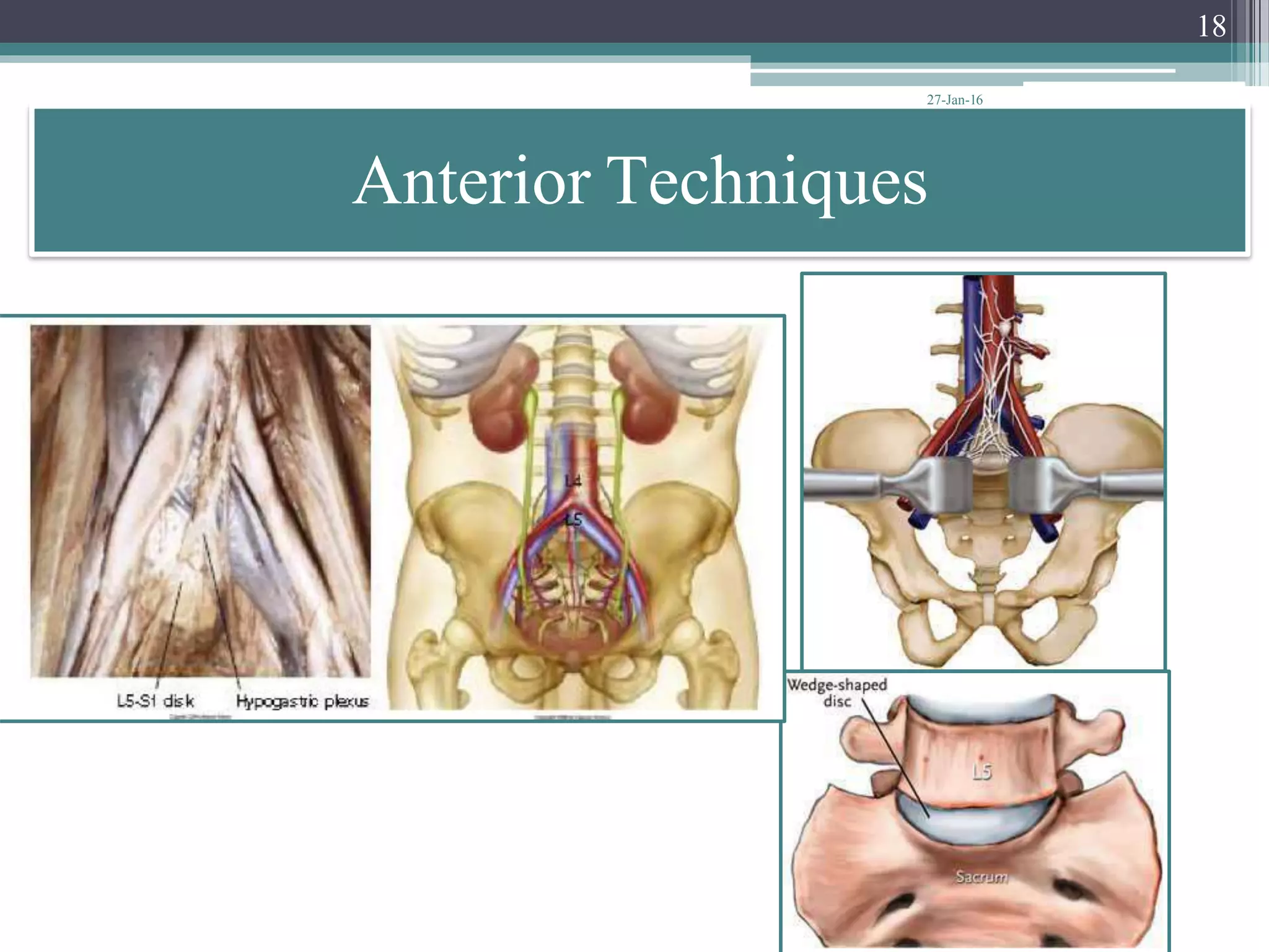lumbar-interbody-fusionindications-techniques-and-complications ...