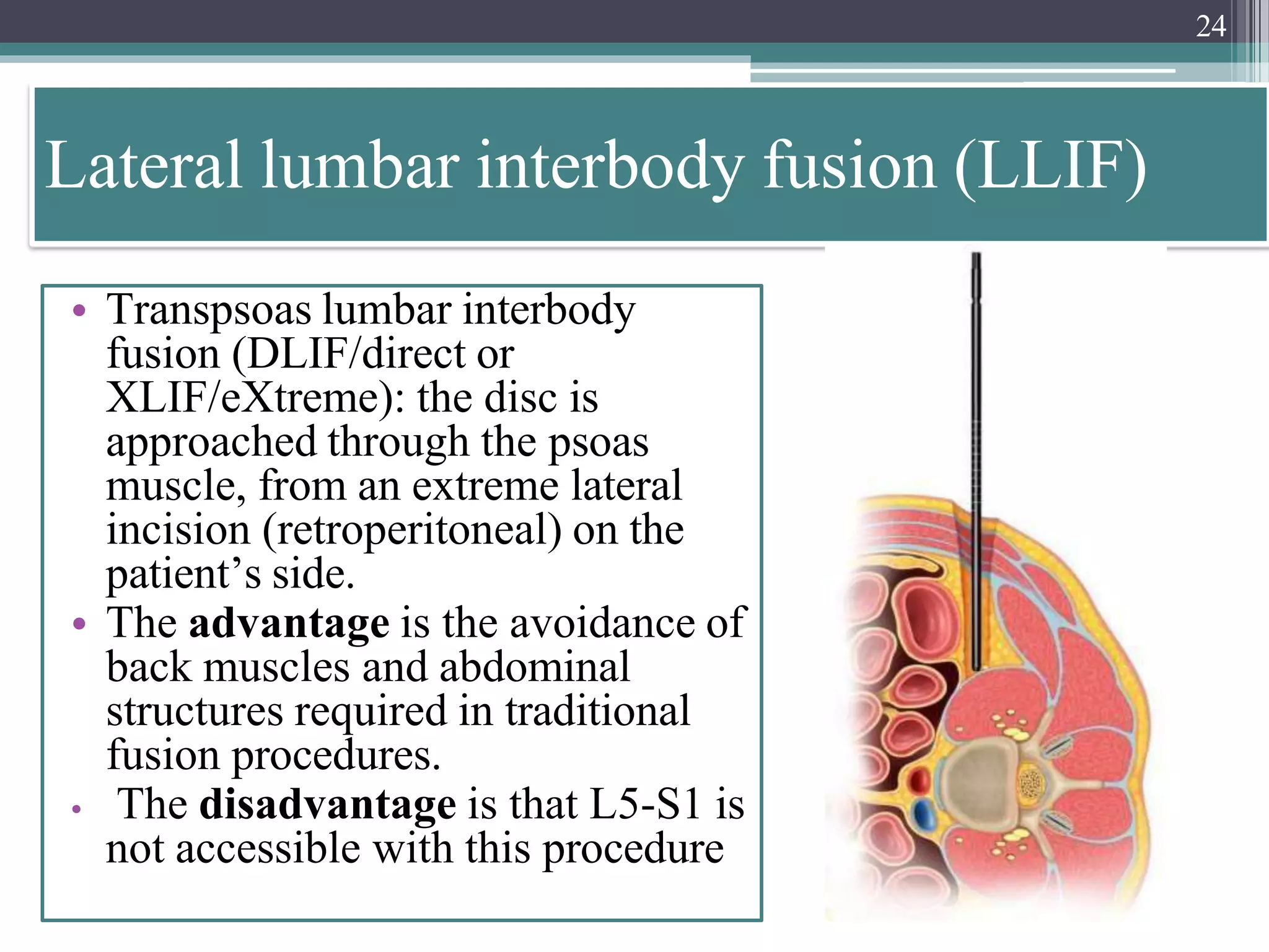 lumbar-interbody-fusionindications-techniques-and-complications ...