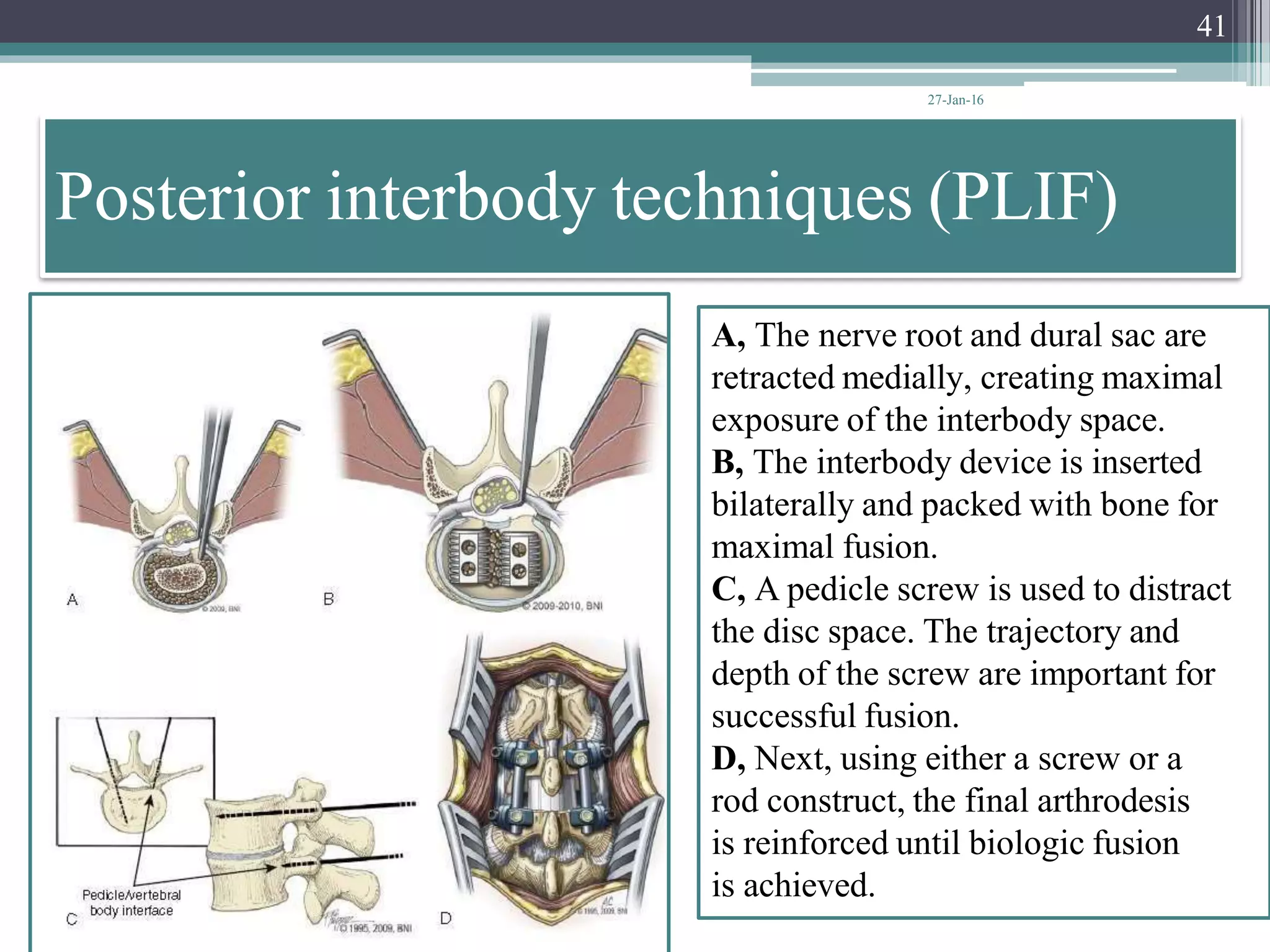 lumbar-interbody-fusionindications-techniques-and-complications ...