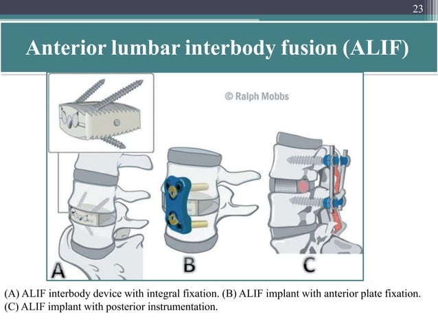 lumbar-interbody-fusionindications-techniques-and-complications ...
