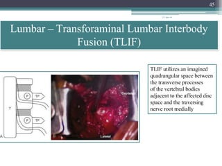 lumbar-interbody-fusionindications-techniques-and-complications ...