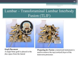 lumbar-interbody-fusionindications-techniques-and-complications ...