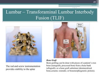 lumbar-interbody-fusionindications-techniques-and-complications ...