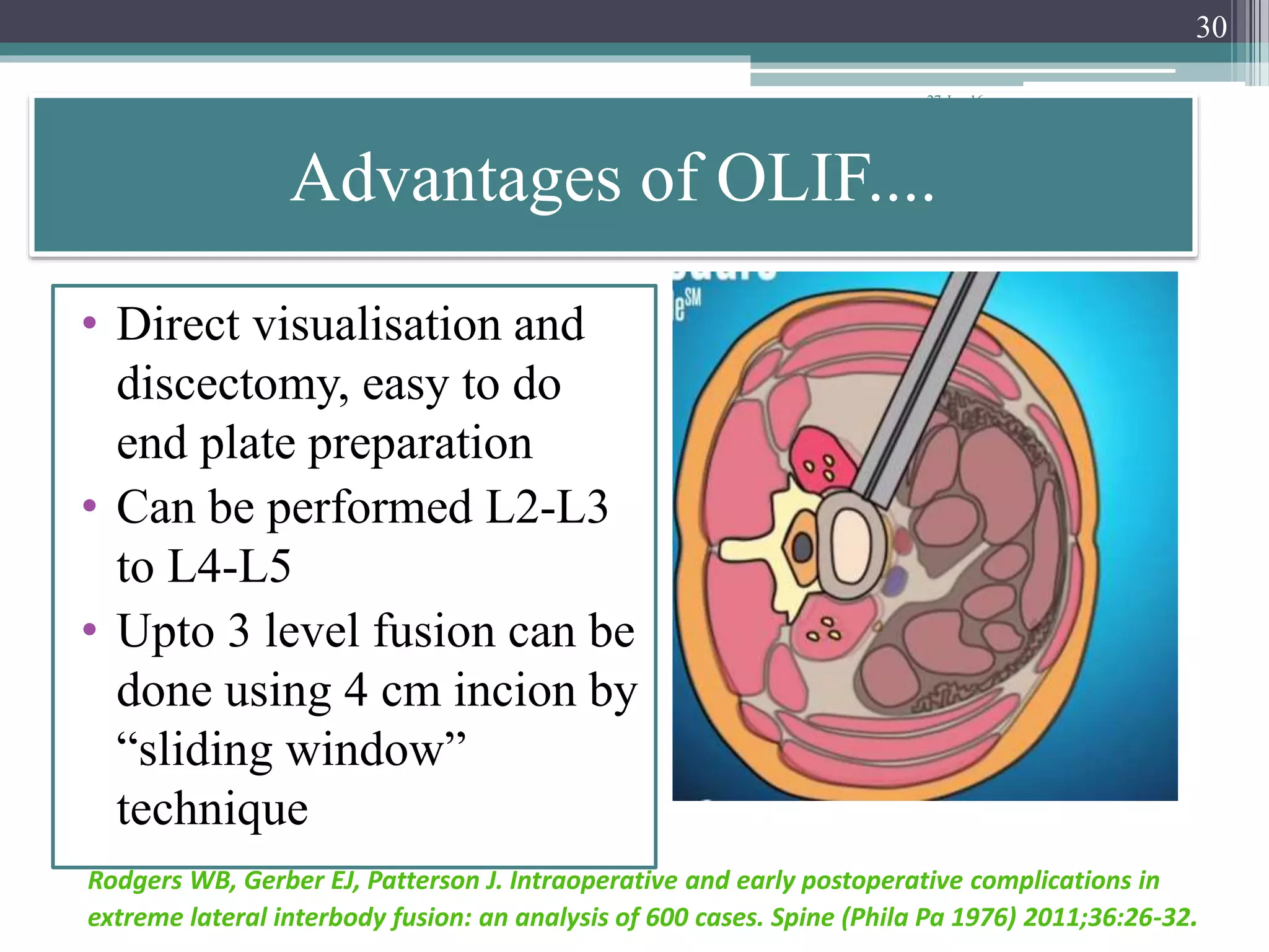 lumbar-interbody-fusionindications-techniques-and-complications ...