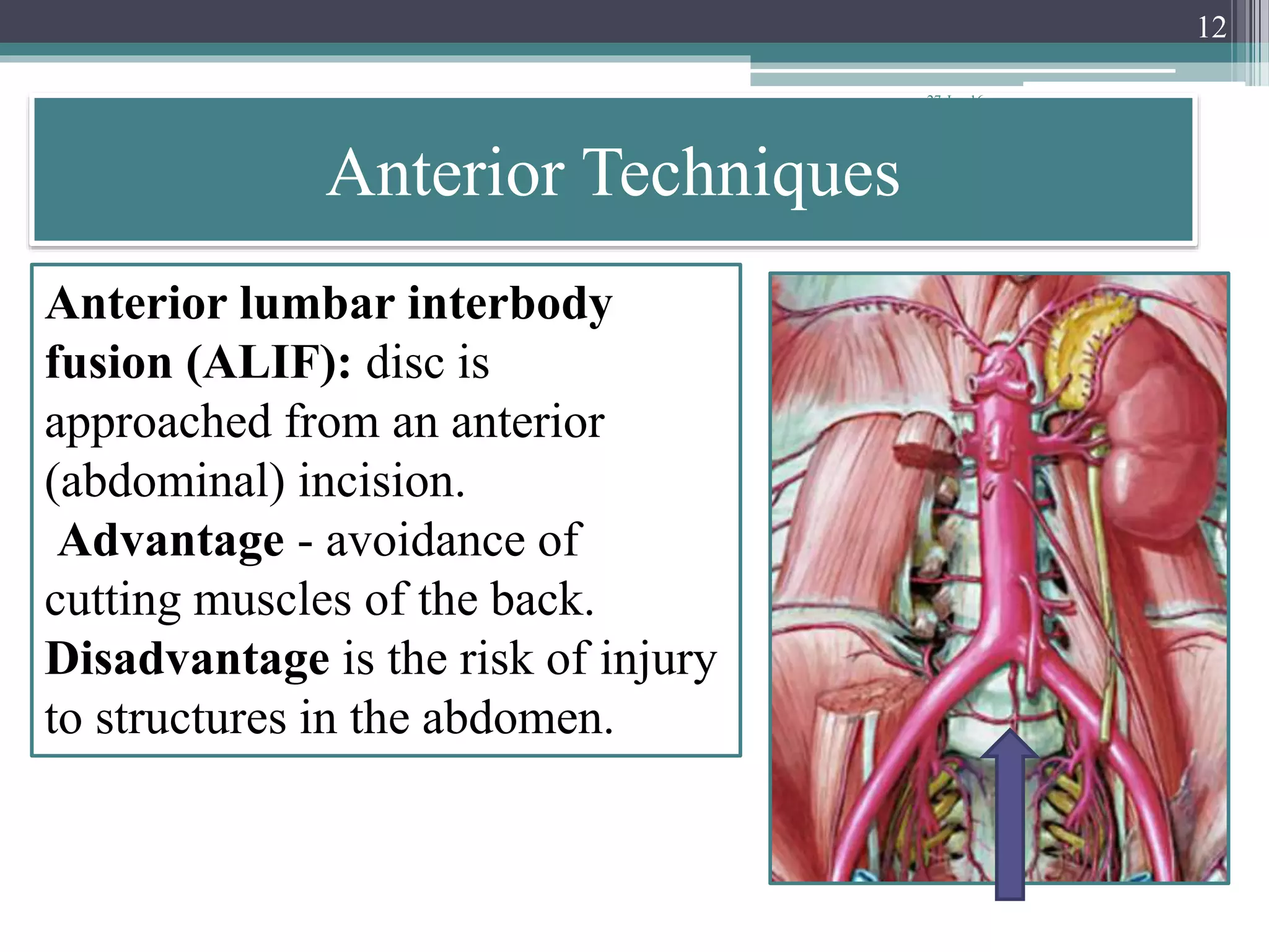 Lumbar interbody fusion indications techniques and complications | PPTX
