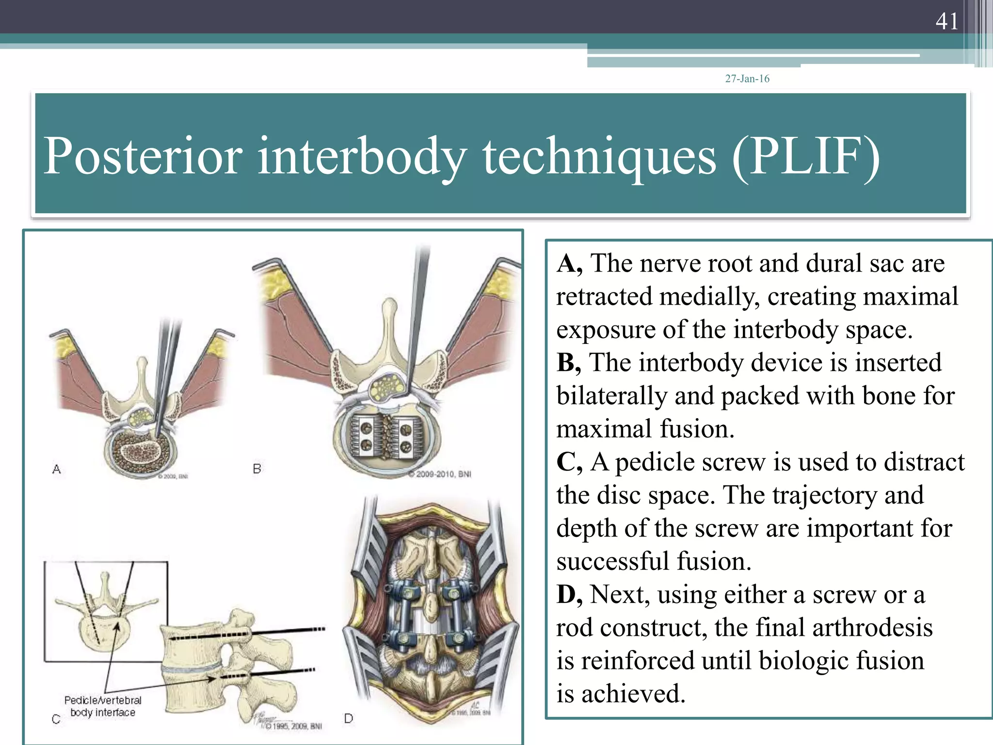Lumbar interbody fusion indications techniques and complications | PPTX
