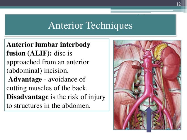 Lumbar interbody fusion indications techniques and complications