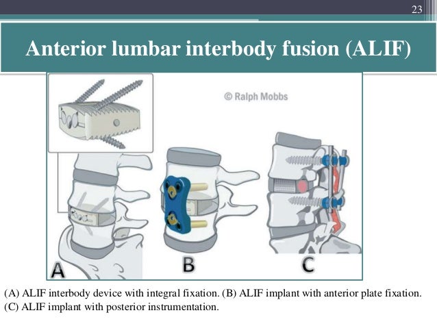 Lumbar interbody fusion indications techniques and complications