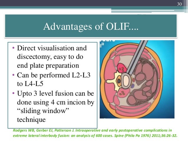 Lumbar interbody fusion indications techniques and complications